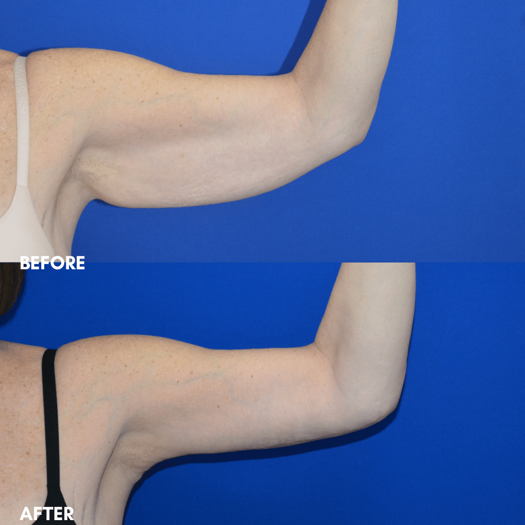 Arm Lift - Brachioplasty - Clearfork Plastic Surgery Center
